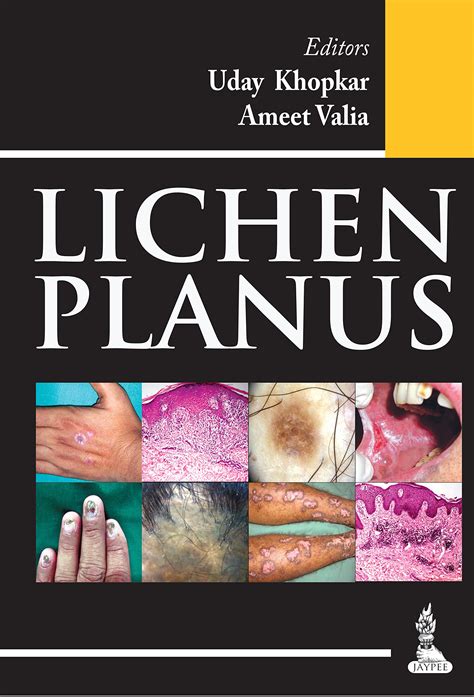 Lichen Planus Pdf Epub Version Downloadable Feetlux Store