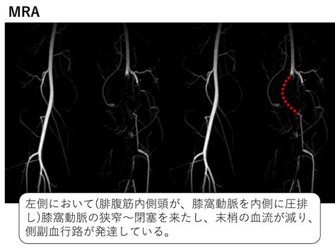 膝窩動脈捕捉症候群popliteal Artery Entrapment Syndromeの画像所見のポイント