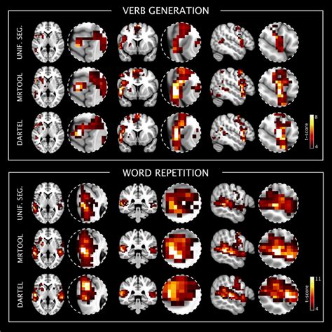 Group Level Cortical Activations Language Tasks Statistical Maps Of Download Scientific