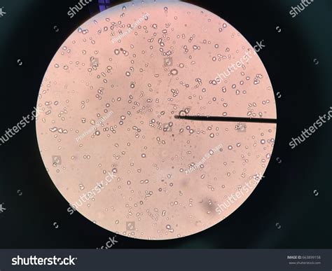 Found Dysmorphic Red Blood Cell Urine ภาพสต็อก 663899158 Shutterstock