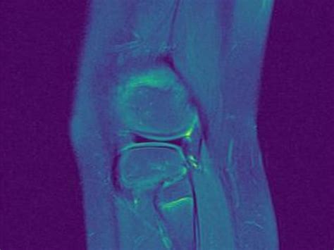 Feature Extraction Mri Images Deep Learning Upwork