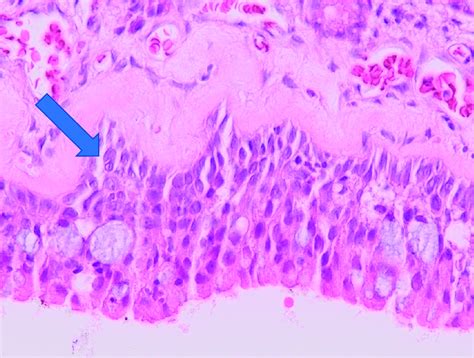 Epithelial Hyperplasia Severity Of Inflammation Grade 1 Arrow