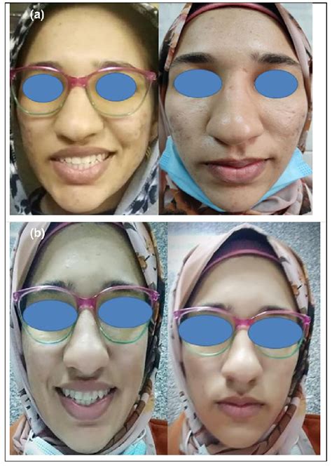 Female Patient With Moderate Acne A Mouth Deviation After Download Scientific Diagram