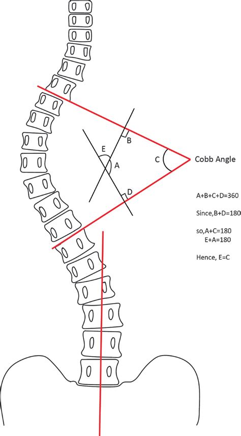Conceptual Design Of A Scoliosis Aiding Brace And A Monitoring