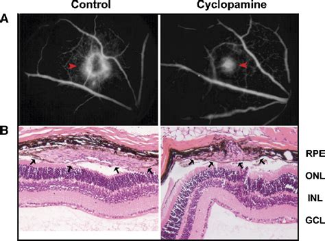 Inhibition Of Ocular Neovascularization By Hedgehog Blockade Molecular Therapy