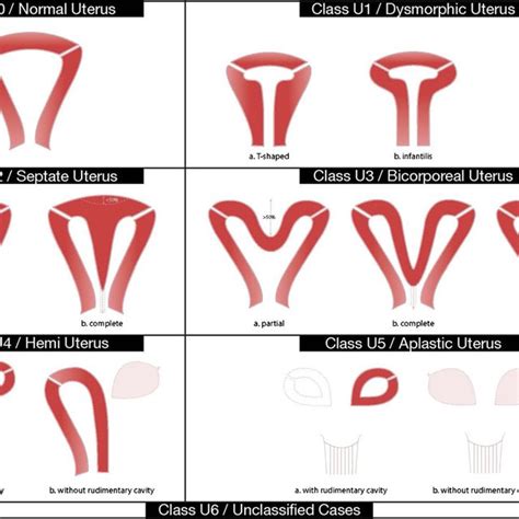 Eshre Esge Classification Of Uterine Anomalies Schematic Download Scientific Diagram