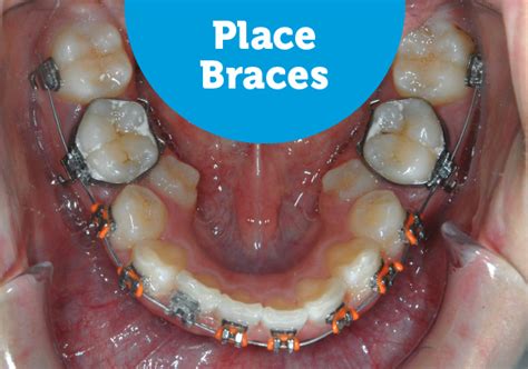 Crowded Back Teeth · Braces In South Brunswick Nj