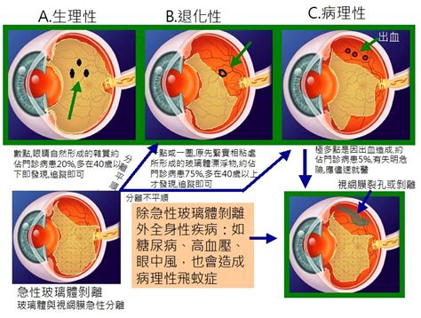 飛蚊症不是病 是眼睛玻璃體退化 優爾視眼科診所 Yours Eye Center