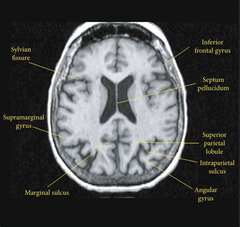 Septum Pellucidum Mri Absent Septum Pellucidum Radiology Case