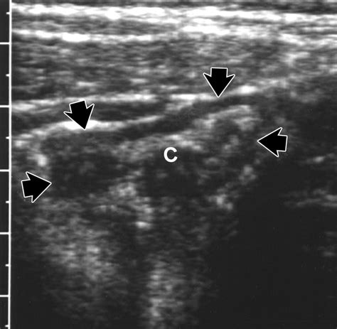 Graded Compression Ultrasound