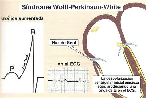 Wolff Parkinson White Ecg Erofound