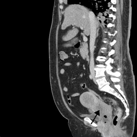 Ct Abdomen Pelvis Sagittal View Showing Soft Tissue Mass Involving