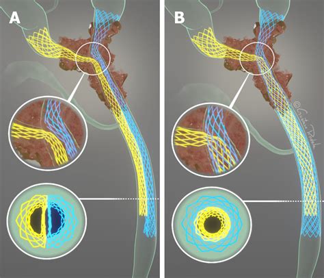 Ercp Stent