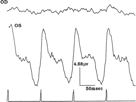 Book Chapter On Clinical Visual Electrophysiology Livorthoptic
