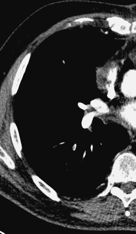 Subsegmental Embolus Missed By Primary Readers Download Scientific Diagram