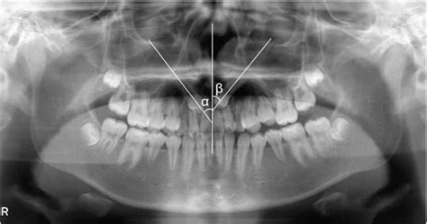 Pretreatment Panoramic Radiograph And Cone Beam Computed Tomography Download Scientific Diagram