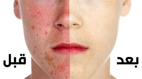 أفضل طريقة لإزالة حب الشباب سريعا وتجميل الوجه بدون عمليات تجميل