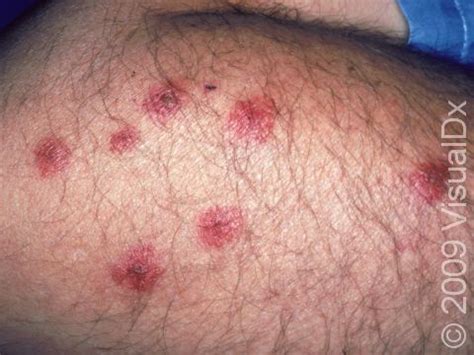 Bed Bug Bites On Genital Area