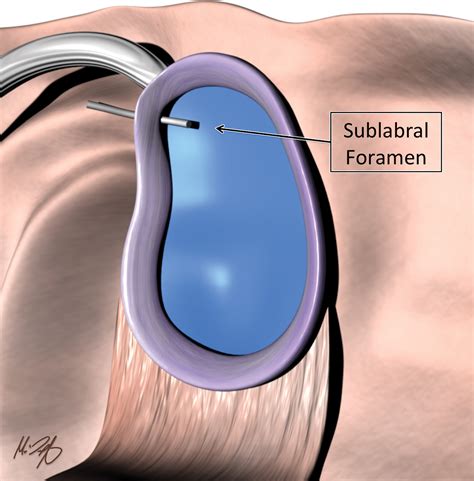 Imaging The Glenoid Labrum And Labral Tears Radiographics