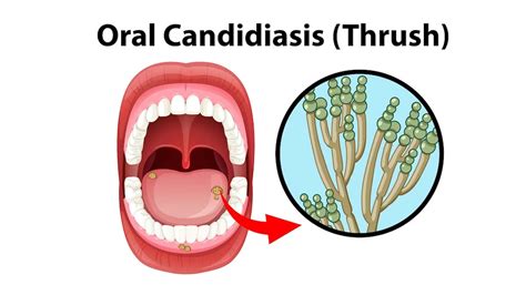 Types Of Candidiasis With Transmission And Pathogenesis 43 Off