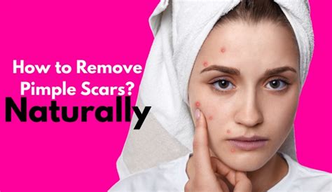 Acne Scar Removal At Home Archives Reviera Overseas