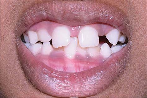 Axenfeld Rieger Syndrome Causes Symptoms Diagnosis Treatment And Prognosis