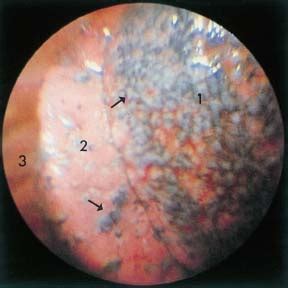 Diffuse Lung Diseases Thoracic Key
