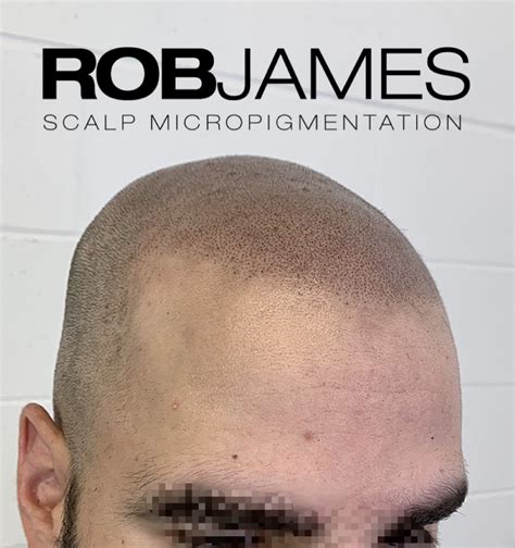 Why Do I Get A Flaky Scalp After My SMP Sessions