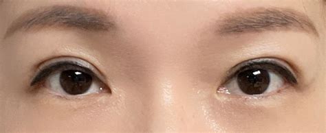 자유수다 대구 엣지성형외과에 강남언니 1등 성형수술and피부시술 정보앱