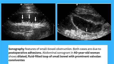 Radiological Imaging Of Small Bowel Obstruction Pdf