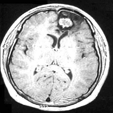 Tumor Segmentation Object Detection Dataset By New Workspace Nyha8