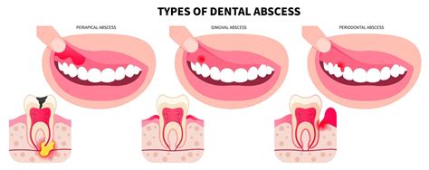 What Is The Difference Between Gum Abscess And Periodontal Abscess