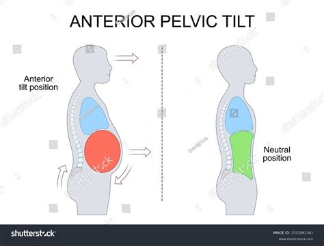 Anterior Pelvic Tilt Pelvic Rotation Lumbar Stock Vector Royalty Free