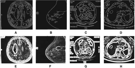 Edge Detection Algorithms For Boundary Detection In Medical Images