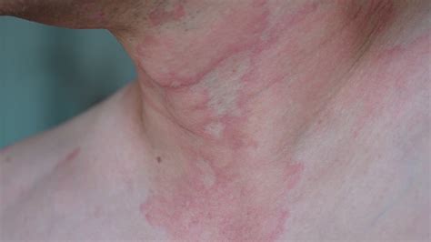 Hives Causes Risks Prevention And Pictures Artofit