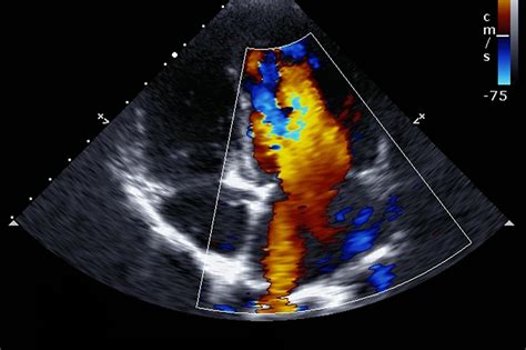 Having An Echocardiogram What You Need To Know UPMC HealthBeat