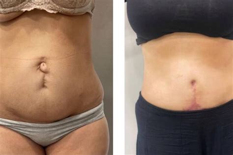 Abdominal Wall Reconstruction In Chennai Dr Pinak Dasgupta