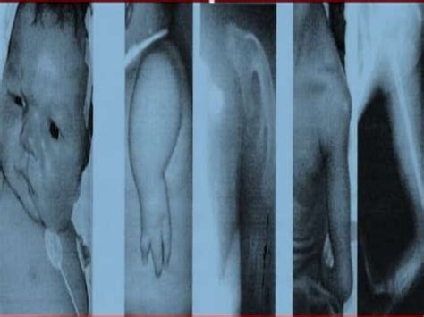 Congenital Anomalies Of Upper Limb Pptx