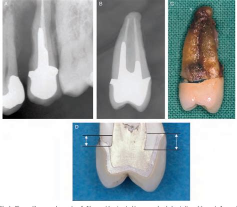Figure 1 From The Compromised Tooth Conservative Treatment Or