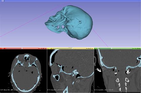 Views Of Case 3 Pmct Dicom Segmentation Showing Left Lateral Download Scientific Diagram