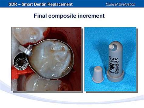 Direct Restorations Dentsply Sdr Smart Dentin Replacement Proximal
