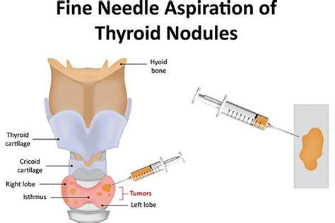 Thyroiduk Fna Betterthyroidhealth Thyroid Uk