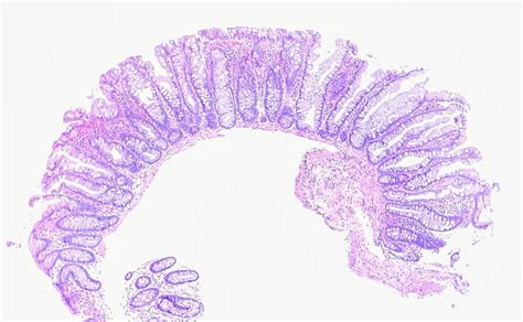 Sessile Serrated Adenoma Pathosomes