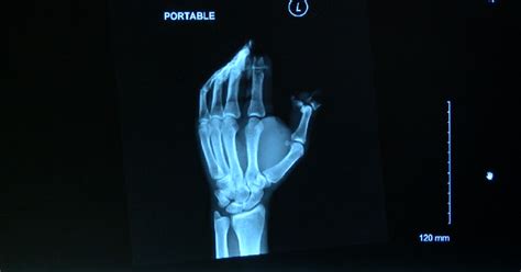 Surgeon Victim Warn Of Firework Hand Injuries Looked Like Hamburger