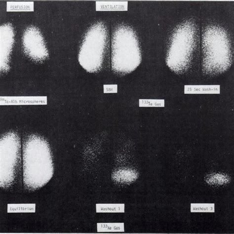 Posterior V Q Scans TakenonSeptember Per Fusion Scan Upper Download Scientific