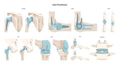 Total Joint Replacement Heiden Orthopedics