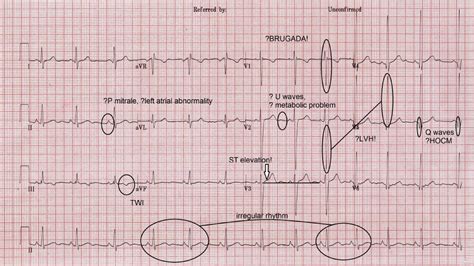 Pathological Q Wave