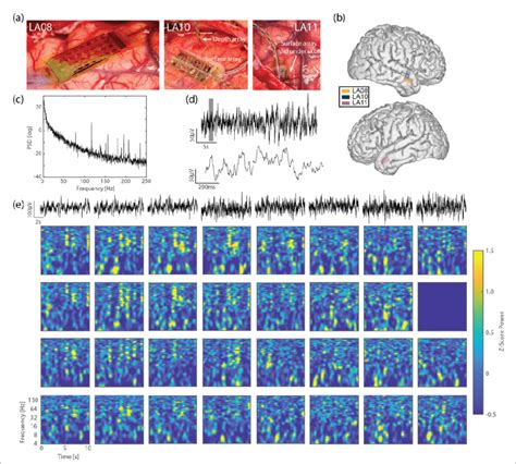 Intraoperative Human Testing Of Thin Film µecog And Ieeg Arrays A Download Scientific