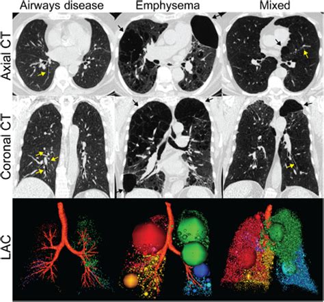 This Is What Copd Looks Like Sheikh 2016 Respirology Wiley Online Library