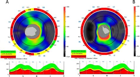 A B Spectral Domain Optical Coherence Tomography Of The Retinal Nerve